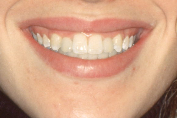 The Maryland bridge is a method used to replace a missing tooth