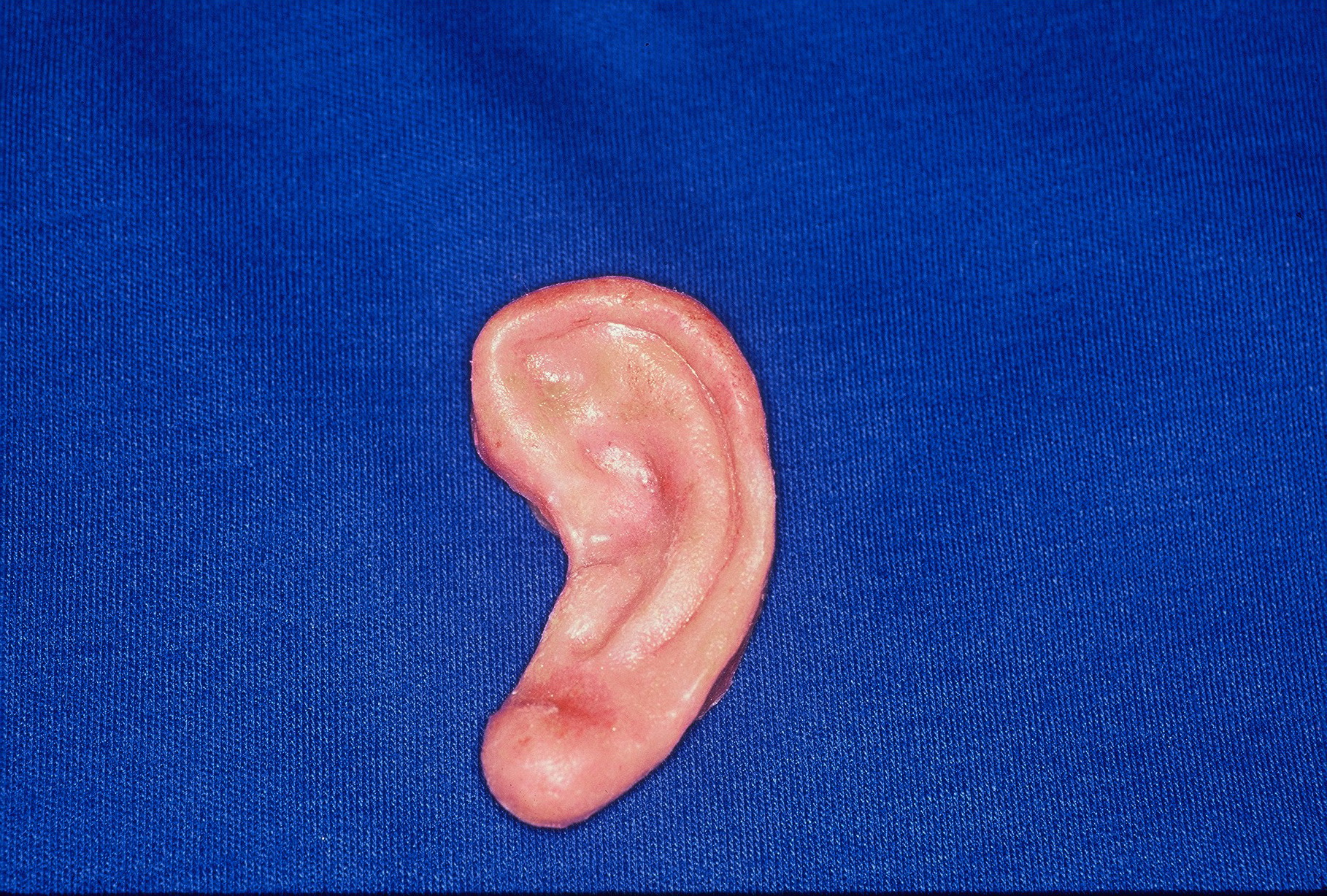 maxillofacial prosthetics cases, ear-nasal-orbital prosthesis